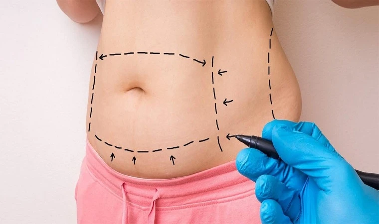 Liposuction Nedir? Yöntemleri Nelerdir? - Gündem Van | Van Haber | Van ... Liposuction Nedir? Yöntemleri Nelerdir? - Gündem Van | Van Haber | Van ...